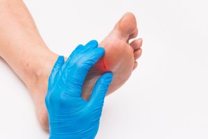 Complications of a Diabetic Foot and how it impacts Foot Amputations