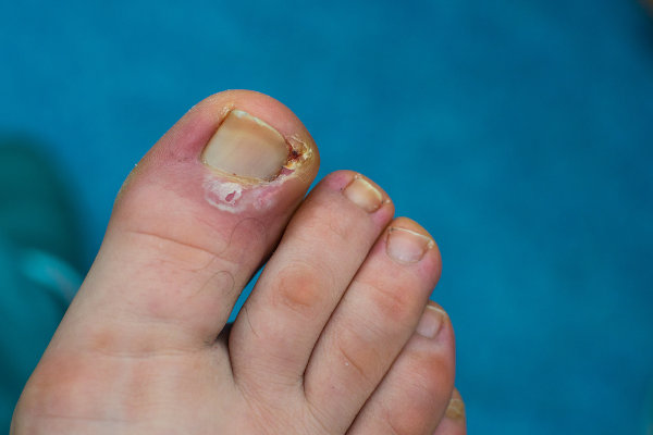 Toenail Staph Infection maybe cause you to experience pain!