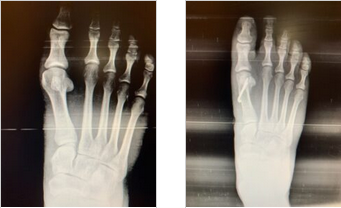 Bunion Surgery Lapiplasty - If you’re considering it please read this!