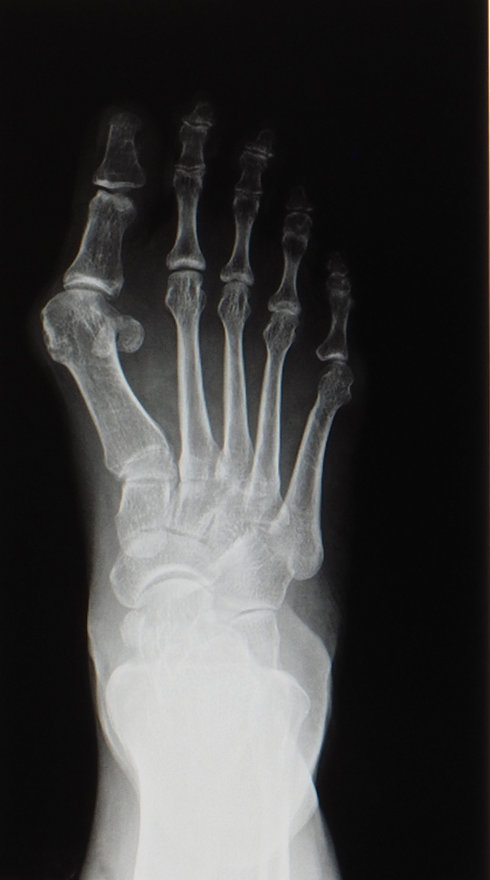 Bunion Surgery Lapiplasty - If you’re considering it please read this!