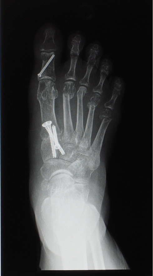 Bunion Surgery Lapiplasty - If you’re considering it please read this!