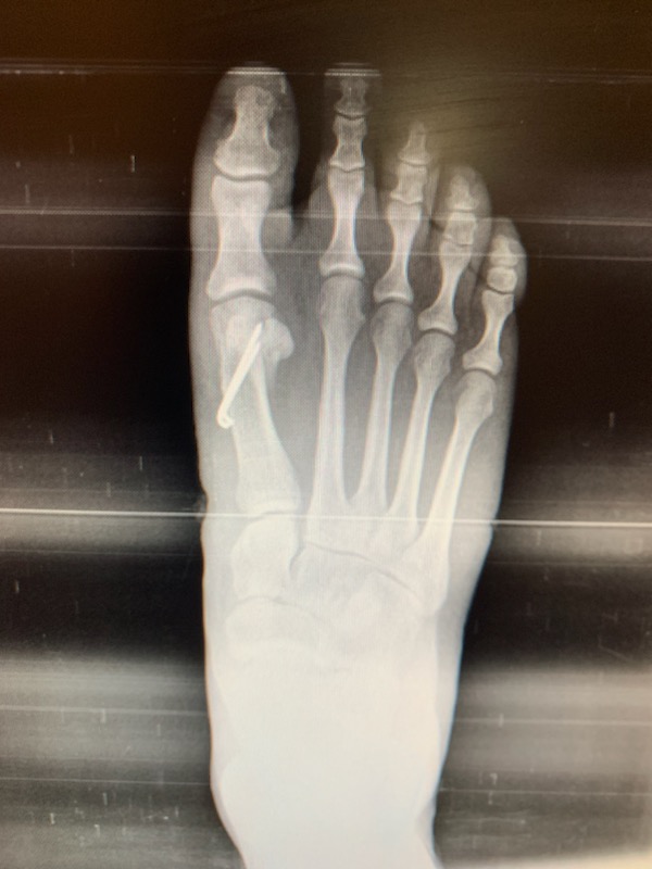 Bunion Surgery Lapiplasty - If you’re considering it please read this!