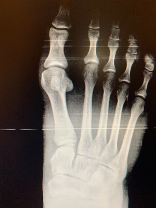 Bunion Surgery Lapiplasty - If you’re considering it please read this!