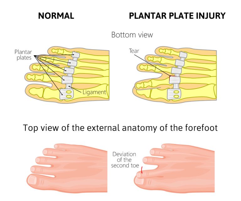 Plantar Plate Tear causing your foot pain? Manage your options.