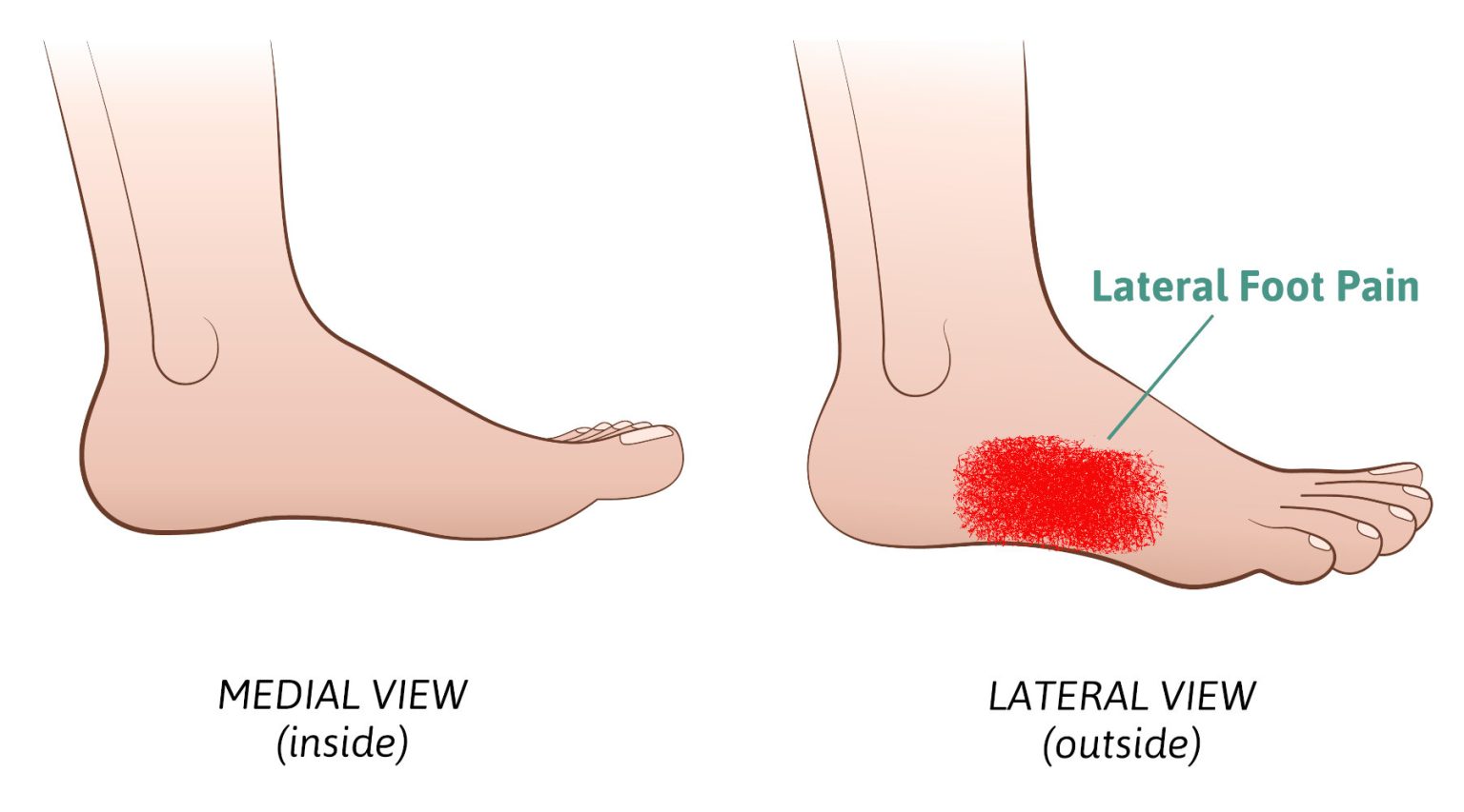 Lateral foot pain? How to get to the source of the problem!